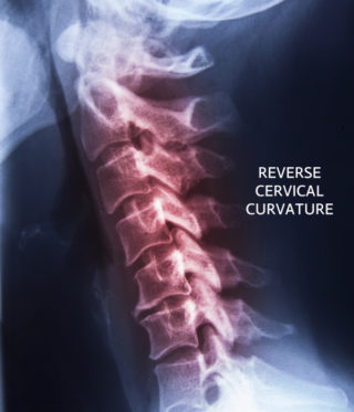 Reverse Cervical Curve - Charlotte Chiropractic Center, PLLC